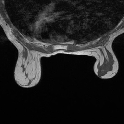 Breast MRI