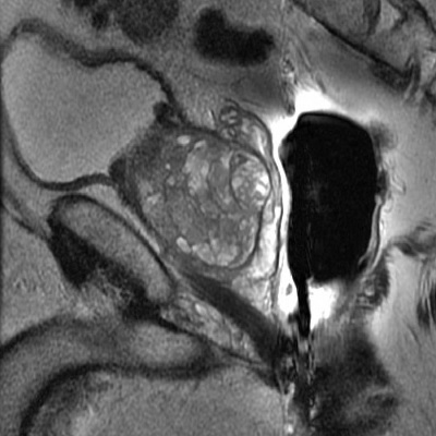 Prostate MRI